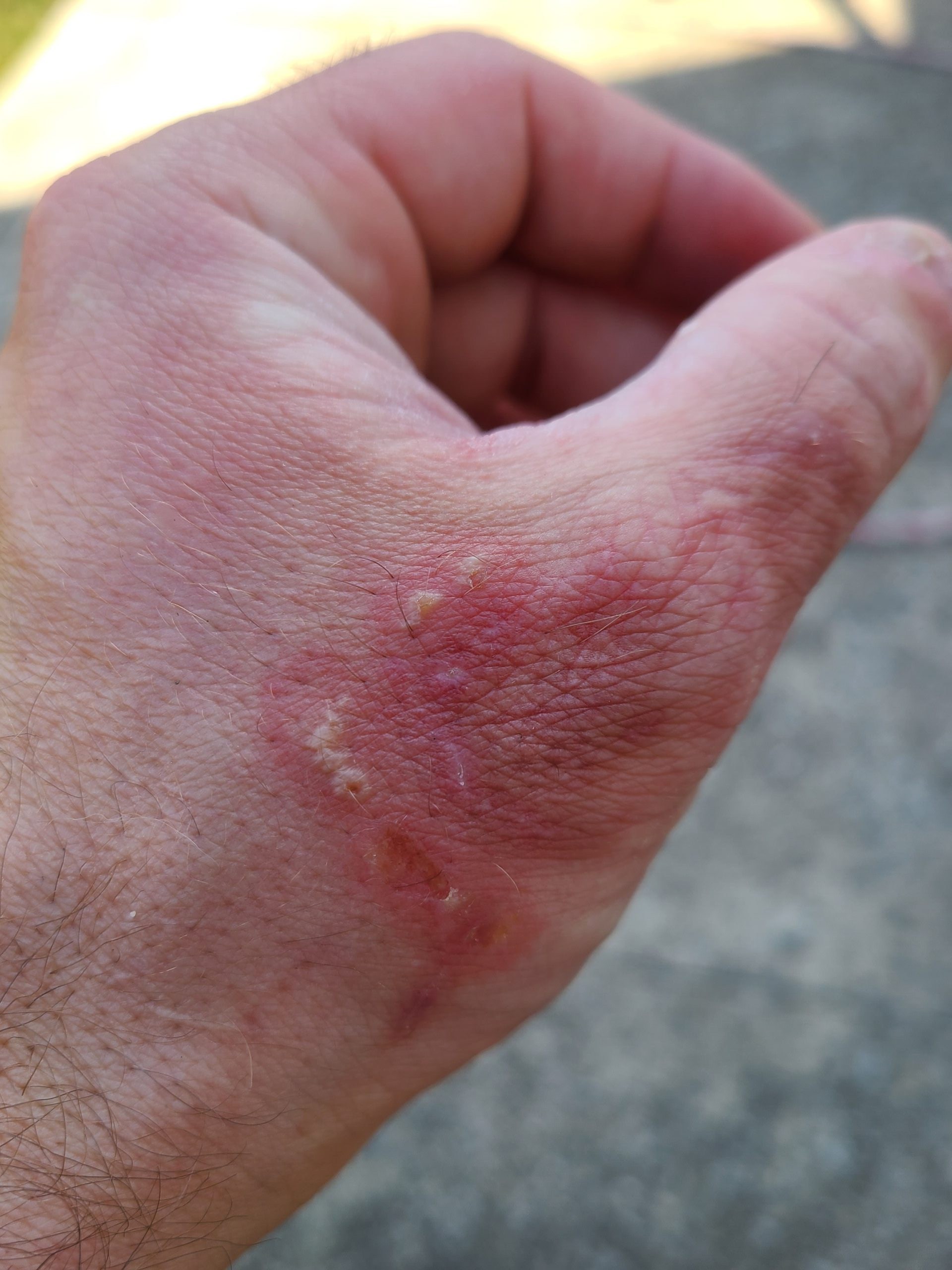 I Got a Nasty, Flesh-Eating Fungal Infection From a Coyote | Outdoor Life