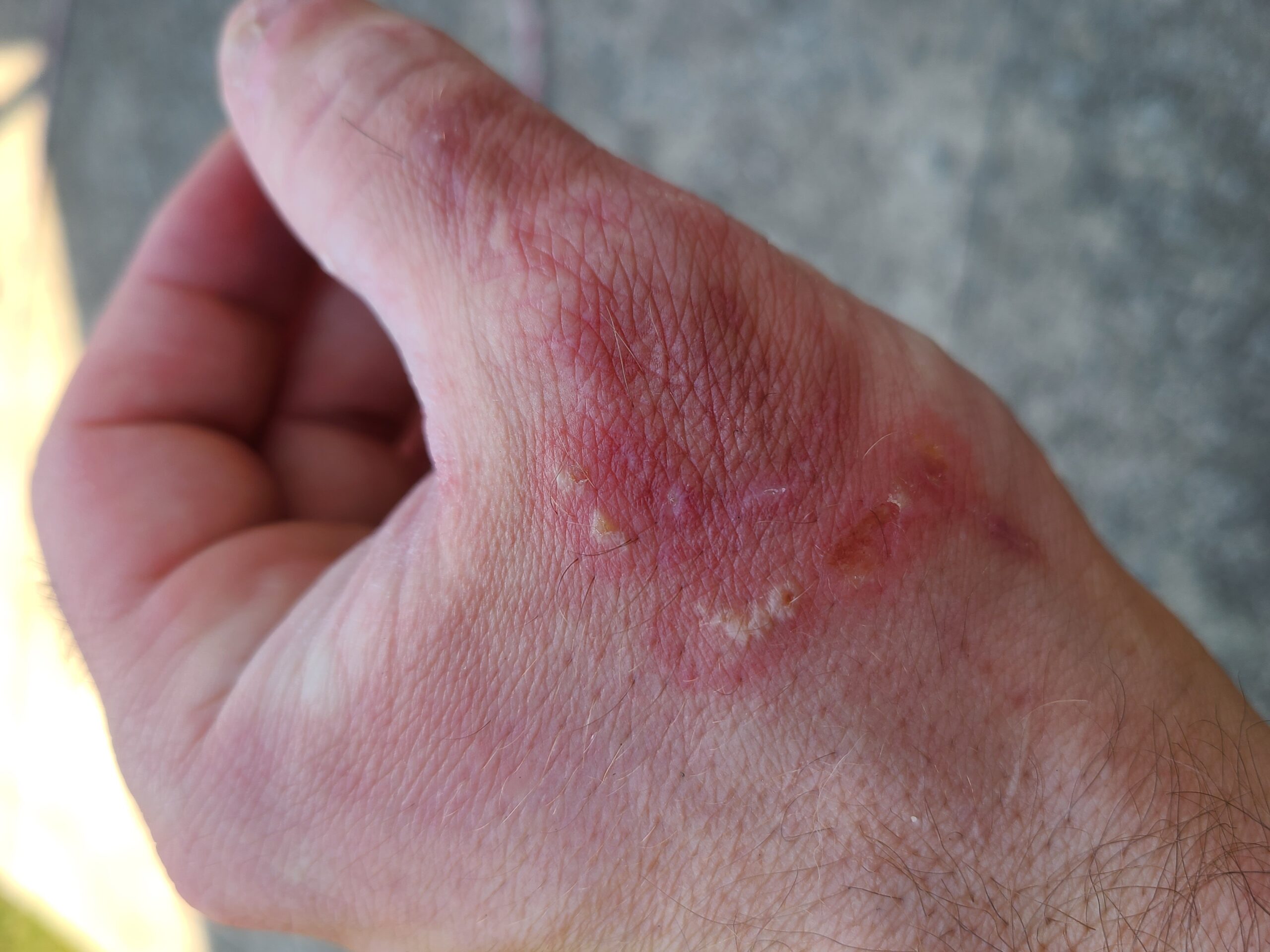 I Got a Nasty, Flesh-Eating Fungal Infection From a Coyote | Outdoor Life