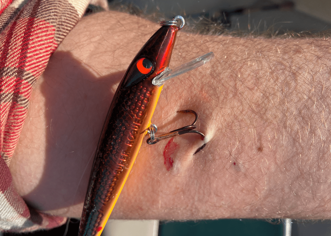 The 6 Most Common Ways Fishing Leads to Injuries, Stitches, and ...