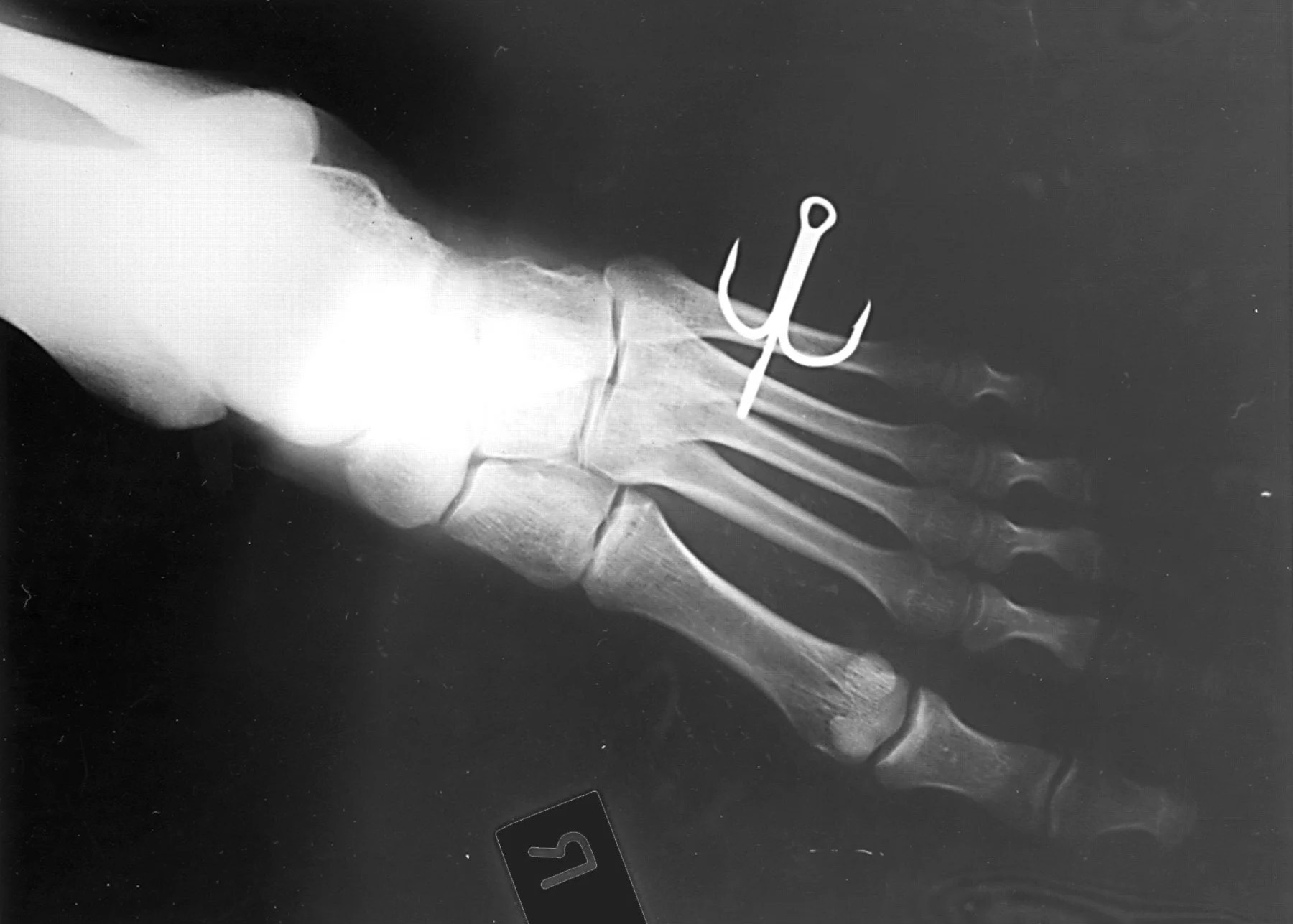 The 6 Most Common Ways Fishing Leads to Injuries, Stitches, and ...