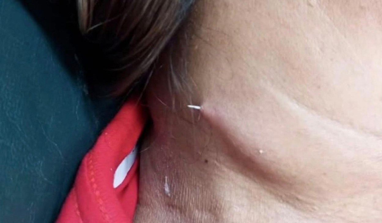 Fish Bone Pierces Thai Woman’s Neck — a Cautionary Tale About Fish ...